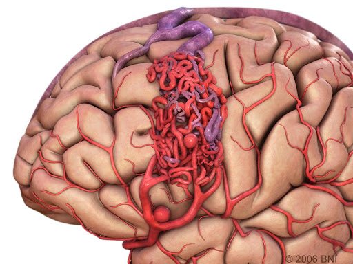 AVM – Aneurysm - Sagar Hospitals